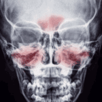 Navigating Chronic Sinusitis ICD 10: Understanding Symptoms ...