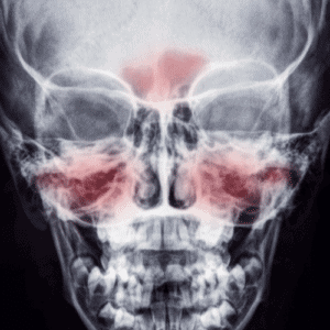Navigating Chronic Sinusitis ICD 10: Understanding Symptoms ...